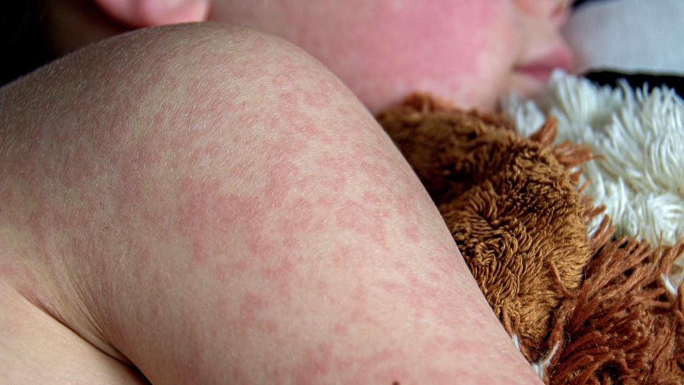 La rougeole : Dix fois plus contagieuse que la COVID | Journal Le Nord